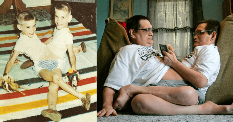 Worlds Longest Surviving Conjoined Twins Ronnie And Donnie Died By Each Others Side At 68